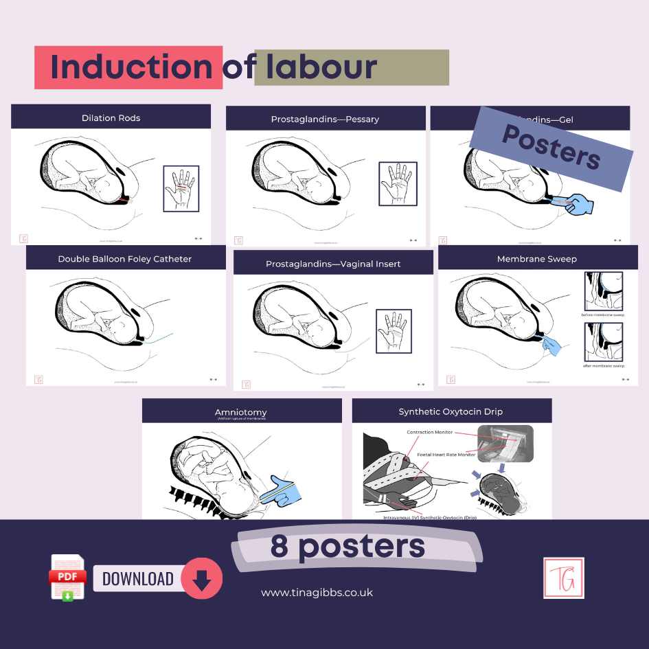 Induction of labour posters (pdf) - Tina Gibbs